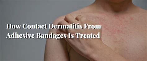 How To Manage Allergy To Adhesive Bandages And Tapes My Healthy Balance