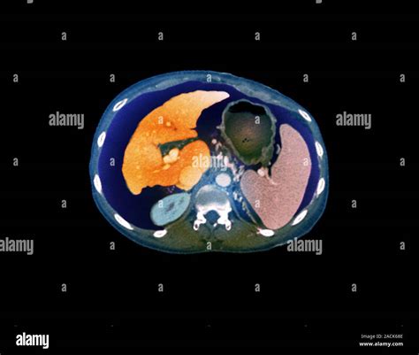 Chronic Liver Disease Coloured Computed Tomography Ct Scan Of An