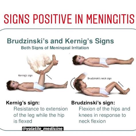 Kernig Leg Sign