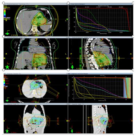Comparison Study For IMRT VMAT And D Conformal In The Treatment Of Gastric Cancer Patients