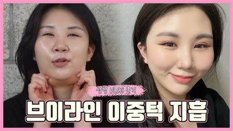 얼굴지방흡입 볼살지방흡입이중턱 제거 2탄 ♥22살 수정씨의 초역대급 레게노 3달동안의 변화과정 후기♥사각턱보름달젖살 얼굴이 이영상 안보면 진심 후회플tv
