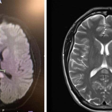 Magnetic Resonance Image Of Brain With Restricted Diffusion In Splenium Download Scientific
