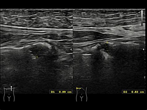 Colon Polyp Ultrasound Cases