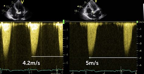 Aortic Valve Echo