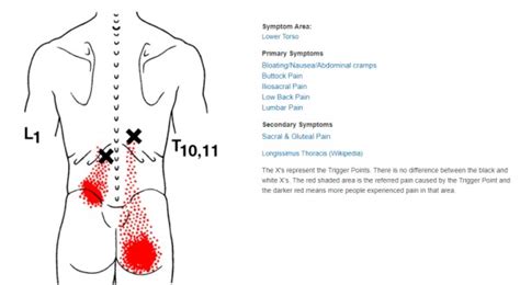 Erector Spinae Trigger Points