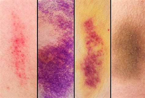 Que Son Los Moretones Coágulo De Sangre O Hematoma Diferencias Y
