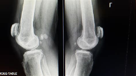 I Ruptured Both My Patellar Tendons At A Trampoline Park Rradiology