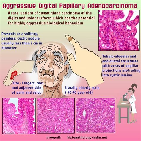 Aggressive Digital Papillary Adenocarcinoma Clinical Pathology Acute
