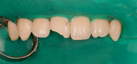 Class Iv Direct Resin Composite Restoration Immediately Post Operative