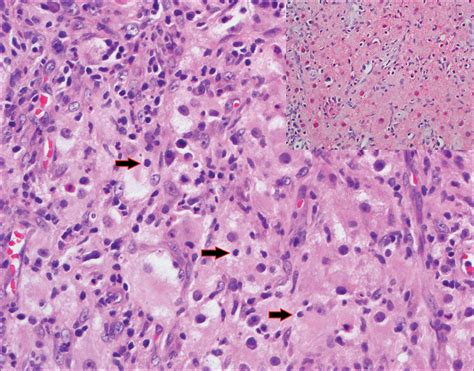 Orange Nodules On The Scalp Mdedge Dermatology