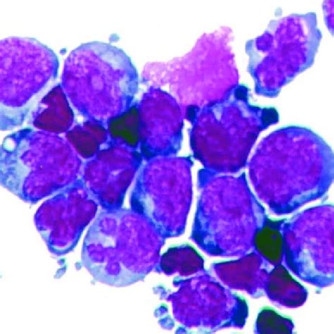 Csf Breast Adenocarcinoma Cell Light Microscopy May Grünwaldgiensa
