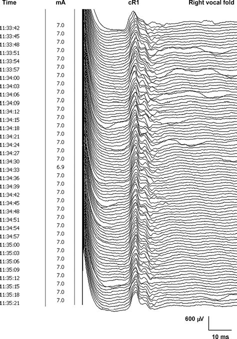 Intraoperative Monitoring Of The Vagus And Laryngeal Nerves With The