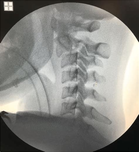 Patient 3 Intra Operative Fluoroscopic Image Showing The Partial Download Scientific Diagram