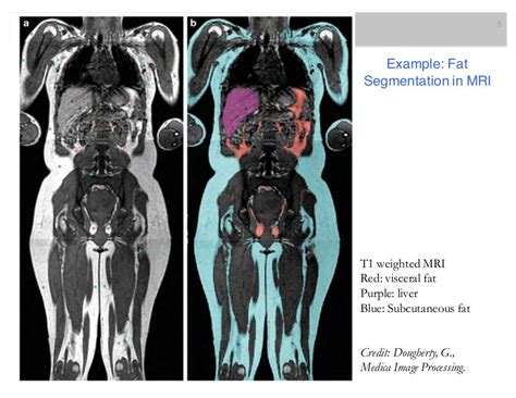 Lec8 Medical Image Segmentation Ii Region Growingmerging