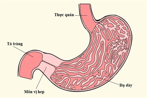Biến Chứng Hẹp Môn Vị Do Loét Dạ Dày Mãn Tính Cách Phòng Tránh Hiệu