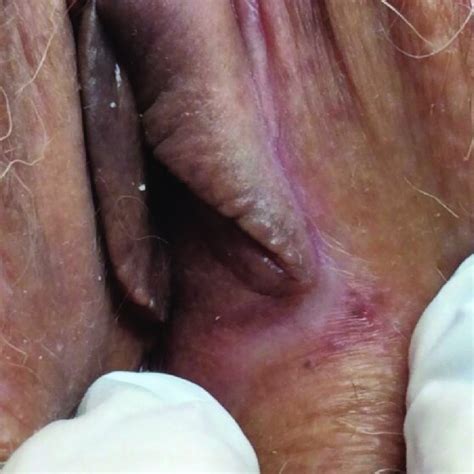 Dermoscopy Of The Primary Skin Lesion Download Scientific Diagram