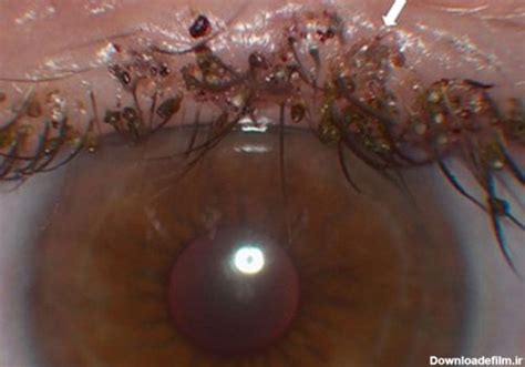 عکس جای نیش حشرات مختلف