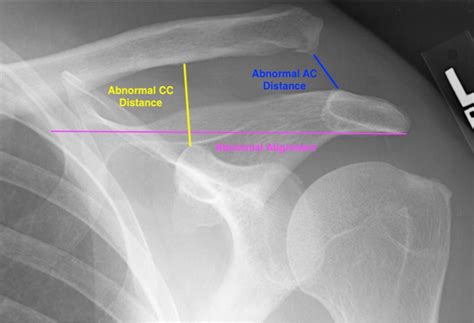 Acromioclavicular Joint Separation Radiopaedia