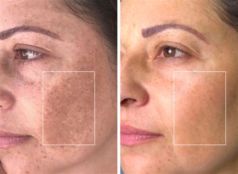 Complexion Code Plus Surplexion