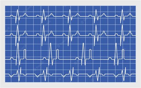 Ekg Flashcards For Class 1 Quizizz