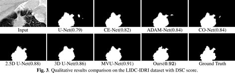Adjacent Slice Feature Guided 2 5d Network For Pulmonary Nodule Segmentation