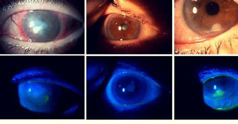 Clínica De Ojos Oftalmic Láser Queratitis Infecciosa