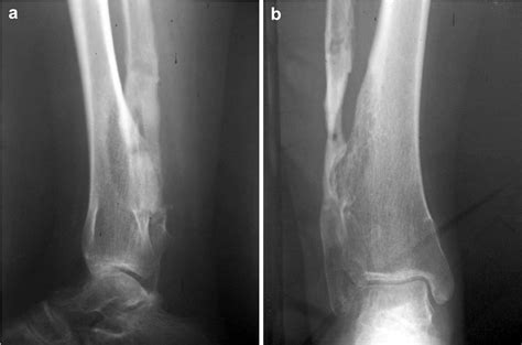 Figure 3 From Transfibular Excision Of Distal Tibial Interosseous