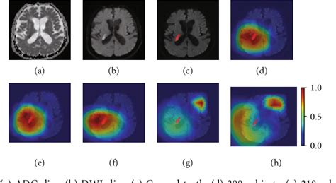 Figure 6 From Deep Learning Based Acute Ischemic Stroke Lesion