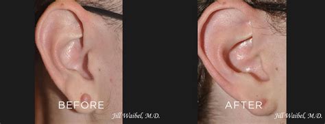 Keloid Scars — Miami Dermatology And Laser Institute