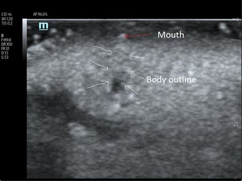 A Rare Encounter Locally Acquired Furuncular Myiasis Botfly In Ohio