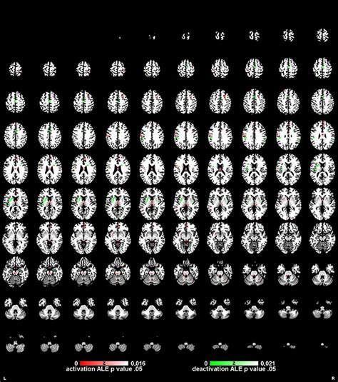 Activation Likelihood Estimation Ale Meta Analysis Of Brain Imaging Download Scientific