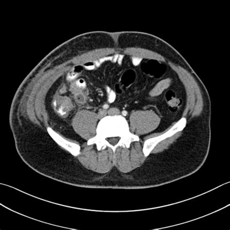 Appendicitis Ct Radiopaedia Appendicitis Is Inflammation Of The Appendix