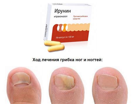 Ирунин от грибка ногтей: состав, свойства, аналоги, отзывы, цена