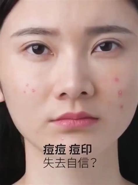 Effective Quickly Remove Pimples Remover Acne Cream Fades Acne Marks Repairs Acne Pits Facial