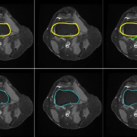 Examples Of Segmentation Using The Random Walker With Our Approach Download Scientific Diagram