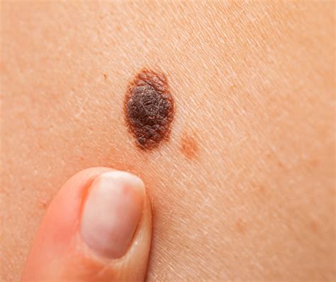 Quins Són Els Símptomes Del Melanoma Dra Casanovas