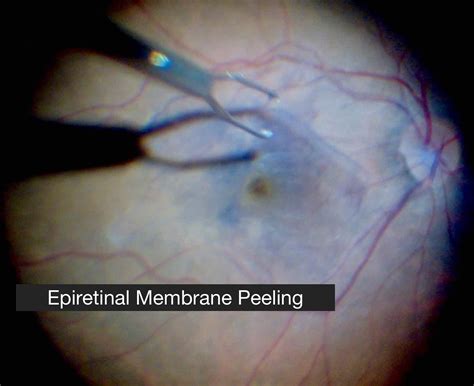 Epiretinal Membrane Treatment Retina Center Tijuana