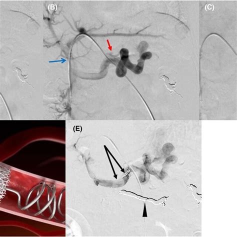 Images Before And During Balloon‐occluded Retrograde Transvenous Download Scientific Diagram