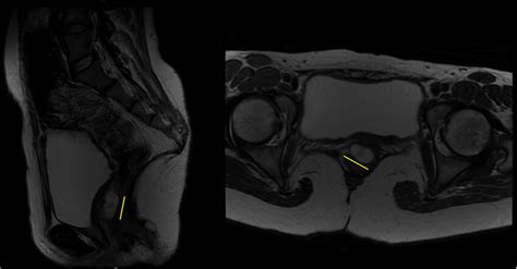 Mri Examination Of The Sigmoid Neovaginal Malignancy Sagittal Upper
