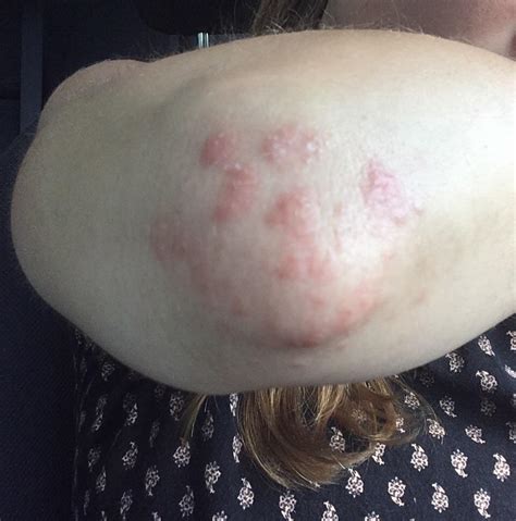 What Is This On My Elbows I Have Always Called It Eczema Based On