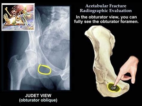 Acetabular Fracture Radiographic Evaluation Video MEDtube Net