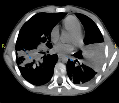 Computed Tomography Of Bilateral Bronchiectasis Bronchiolectasis With Download Scientific