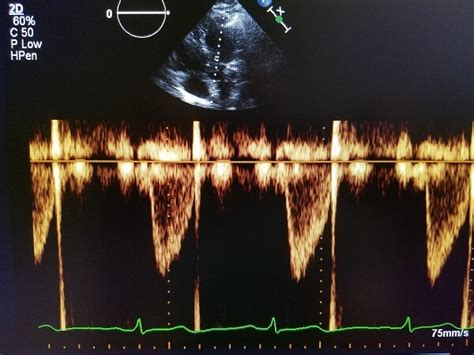 How To Calculate Stroke Volume In Echocardiography The EASY Way