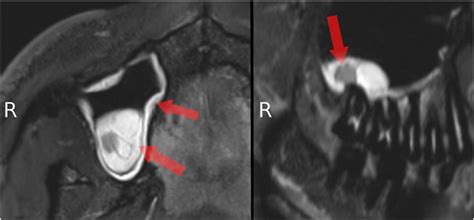 Detail Of Upper Jaw And Adjacent Maxillary Sinus Mucosal Thickening Download Scientific