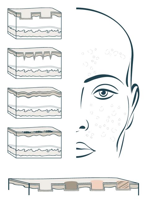 Acne Scar Treatment In Lehi Utah Smart Skin Dermatology