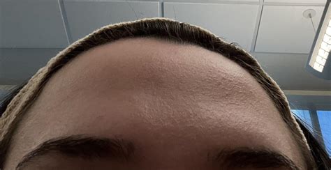 How To Get Rid Of This Texture R SkincareAddicts