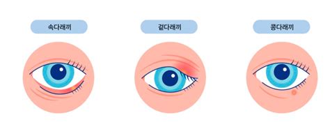 태어나 처음 눈다래끼