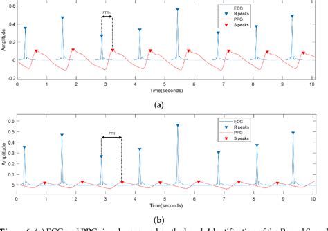 Figure 1 From Validation Of A New Ankle Brachial Index Measurement System Using Pulse Wave