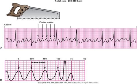 Chapter 8 Atrial Flutter And Fibrillation Flashcards Quizlet