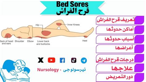قرح الفراش أسبابها علاجها كيفية تجنبها Bedsores Youtube